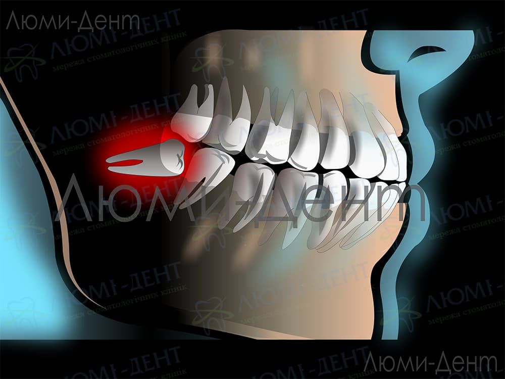 Гній біля зуба мудрості🦷Лікування в Києві🦷ЛюміДент